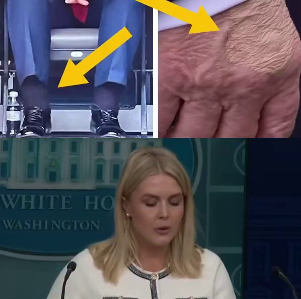 Donald Trump has been diagnosed with “chronic venous insufficiency ...